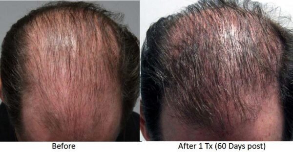 Eclipse Micro Needling with PRP - Prescription Aesthetic and Wellness